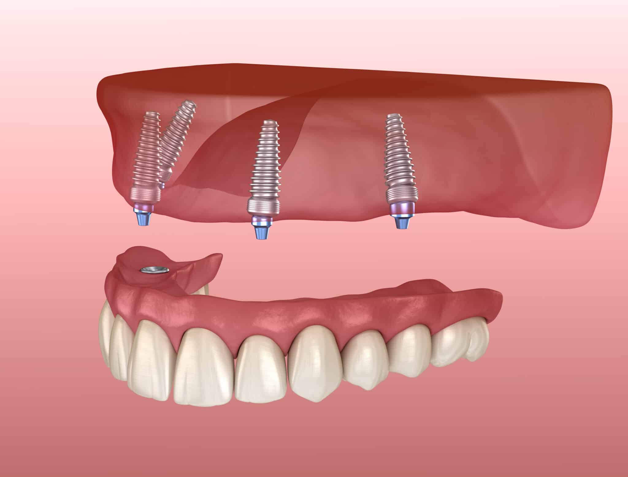 All On 4 Dental Implants | Procedure & Benefits